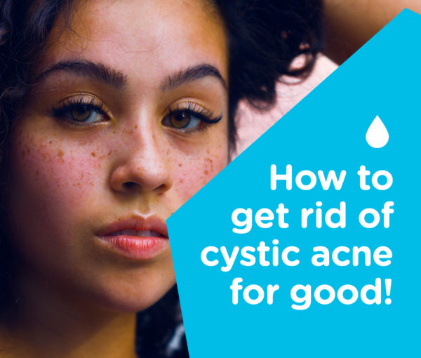 The Truth About Cystic Acne and How You Can Finally Get Rid Of It