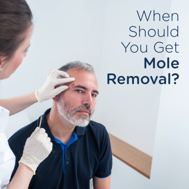 When Should You Get Mole Removal? | Skin Wellness Dermatology